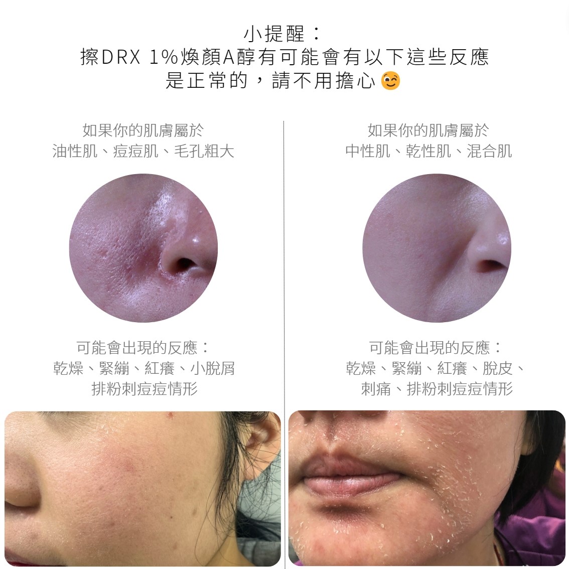 不要長青春痘是大家的願望，DRX達特仕的DRX 1%煥顏A醇，是煥膚的第一選擇！高濃度A醇能夠激活皮膚代謝、延緩衰老，改善皮膚粗糙、皮膚細紋、皮膚皺紋，代謝青春痘、粉刺！青春痘肌膚、粉刺肌膚 ...